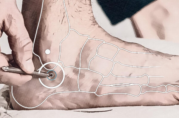 Akupunkturpunkt Bl 62 | Schnell und einfach finden