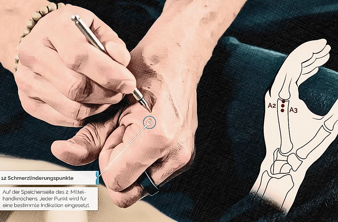 Akupunkturpunkt EX A01–A12 | Geheimnisvolle Schmerzpunkte